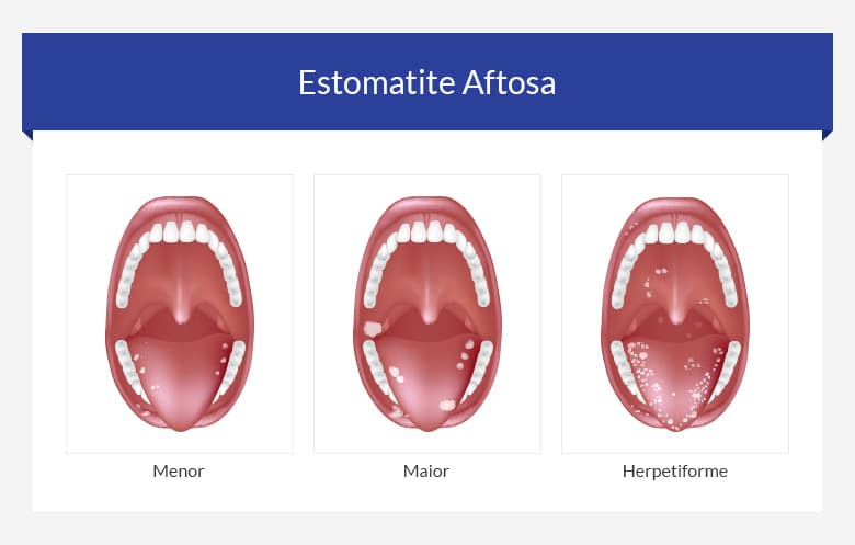 Afta • Causas, Sintomas & Tratamentos • euroClinix®