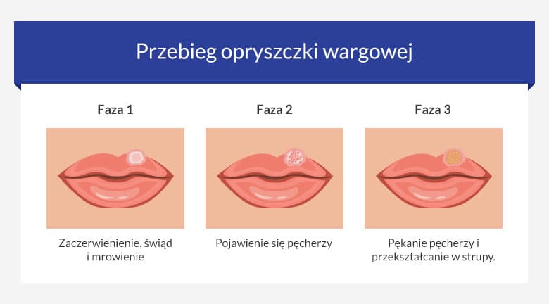 Opryszczka • Kup leki na opryszczkę wargową online w euroClinix®