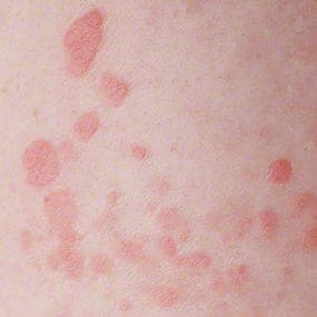 Psoriasis • Läs om symptom och behandlingar • euroClinix®